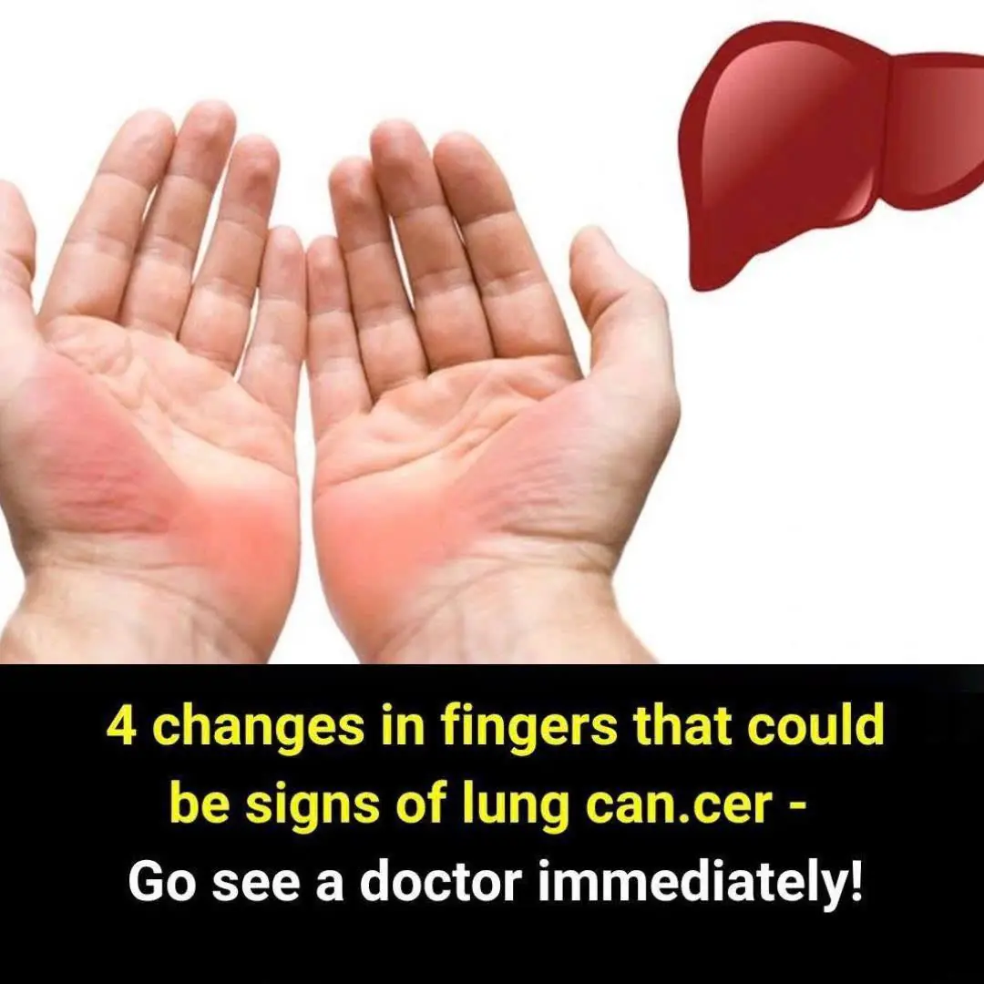 Four Finger Clues That Might Signal Lung Cancer — Don’t Ignore Them